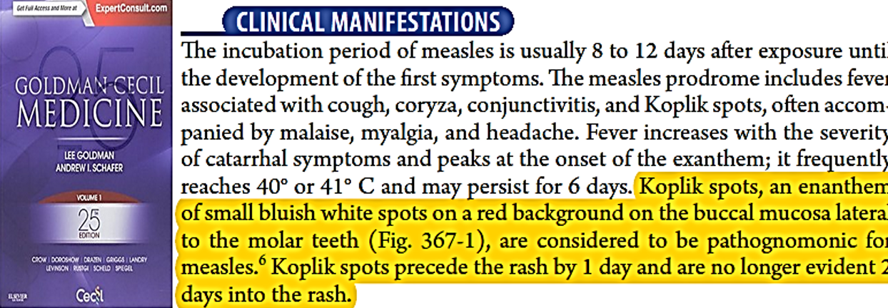 KnowMed: MCQ - Pathognomonic Sign of Measles
