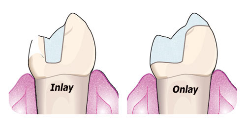 Restoring the Badly Damaged Teeth Back to Normal | Oracare Dental Clinics