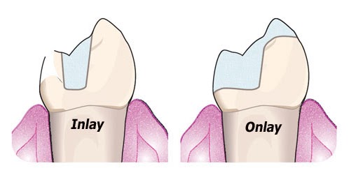 Restoring the Badly Damaged Teeth Back to Normal | Oracare Dental Clinics