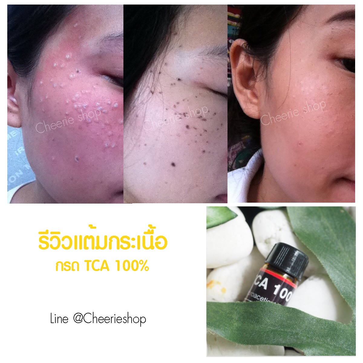 กรดTCA 100% 50% ใช้อย่างไร ให้เกิดประโยชน์ ไม่นำโทษมาให้เคืองใจ: มิถุนายน 2015