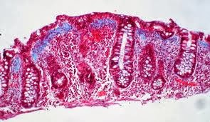 Medical Treatment Pictures-for Better Understanding: Collagenous Colitis