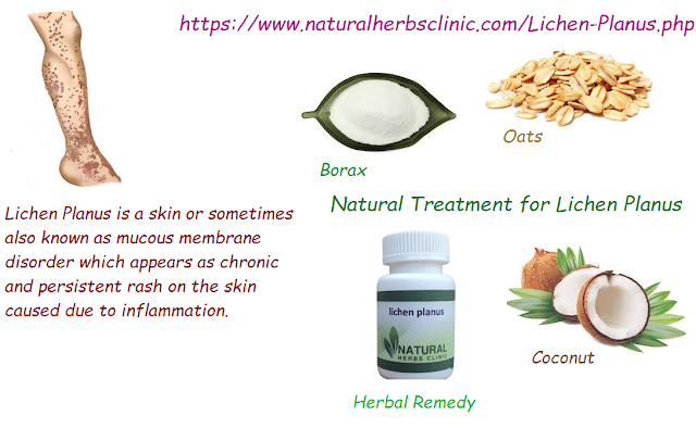 Lichen Planus Definition: Types and Treatment Technique