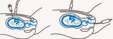 Medical Treatment Pictures-for Better Understanding: Suction Curettage ...