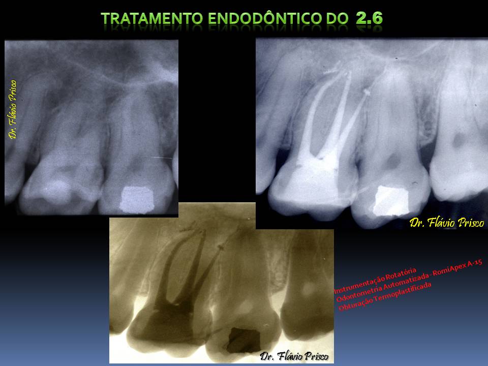 Descobrindo e explorando a Endodontia : Surplus ( " puff " )