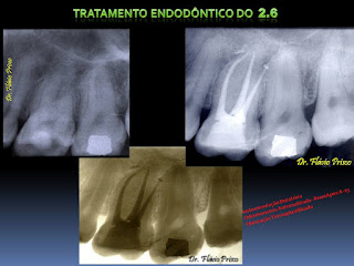 Descobrindo e explorando a Endodontia : Surplus ( " puff " )