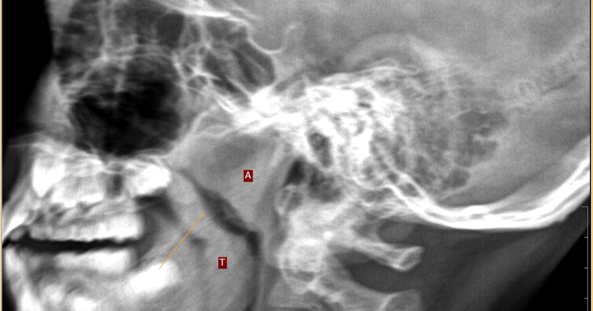 Adenoid Hypertrophy : X-ray - Sumer's Radiology Blog