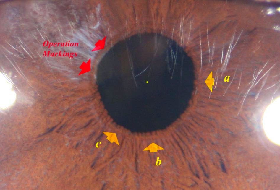 Modern & Multidimensional Iridology: Pupil Flattenings - Physical ...