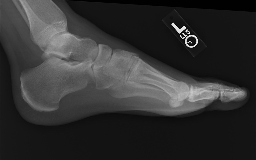 Chip Bone Fracture Treatment | Surgery | Chip Bone Recovery