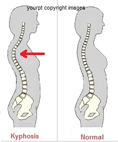 Your Physical Therapy: Kyphosis (Hunchback) Types and Causes