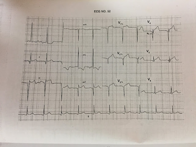 ECG EXERCISE 51,52