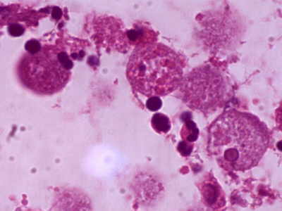 Amebiasis Intestinal: Amebiasis Intestinal