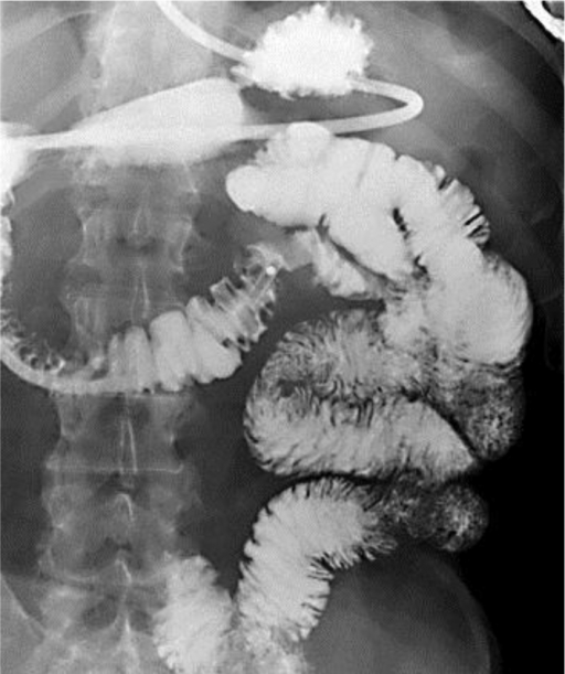 Hello USA: enteroclysis