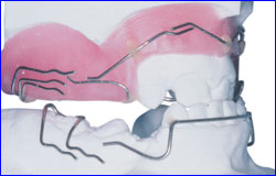 APARATOLOGIA ORTOPEDICA: FRANKEL III