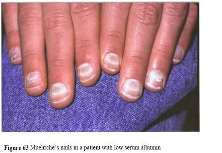 White fingernails and liver disease - Awesome Nail