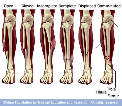 i love physical therapy: Mayo classification for olecranon fractures