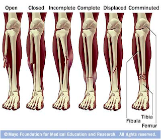 i love physical therapy: Mayo classification for olecranon fractures