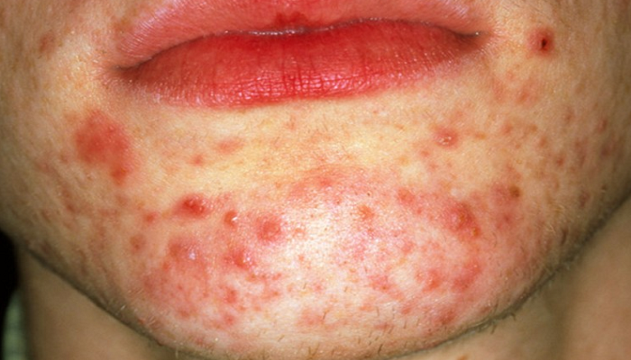 Akne Vulgaris Bilder - Akne Medikament