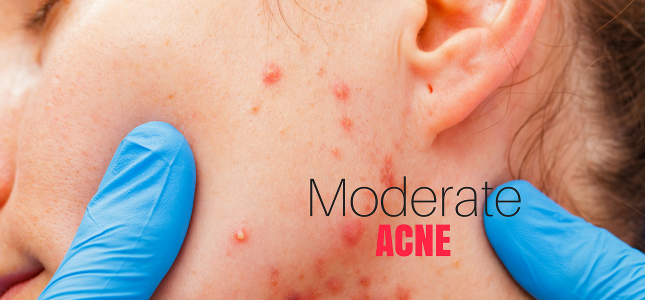 How to Deal with Different Type of Acne? - Skin Care Blog - Clinica ...
