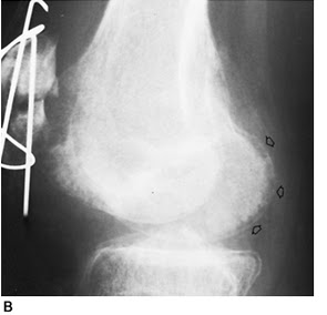 ON - RADIOLOGY: Disuse osteoporosis follows prolonged immobilization