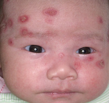 Baby Rash on Face, Cheeks and Neck - Please Doctor