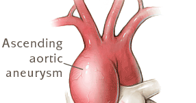 Health Care Information: Ascending aortic aneurysm