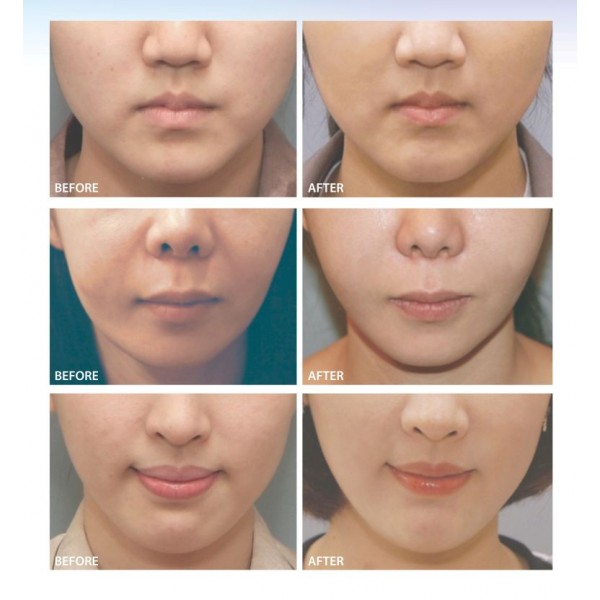 Clique Clinic: Ultra V Lift