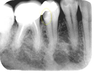 Integral 2012 Dra Cerda: caries radicular y residual