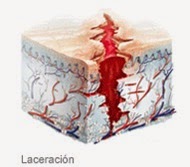 BICHYDERMA: LACERACIONES