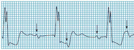 Third degree atrioventricular block / Complete heart block - ECG