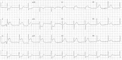 ECG of the Week: ECG of the Week - 22nd June 2015 - Interpretation