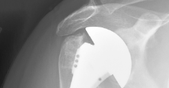 UW Shoulder and Elbow Academy: The ream and run procedure for shoulder ...