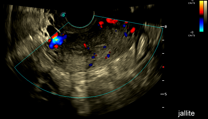 Varices Pelvicas en Paciente con Útero Bicorne