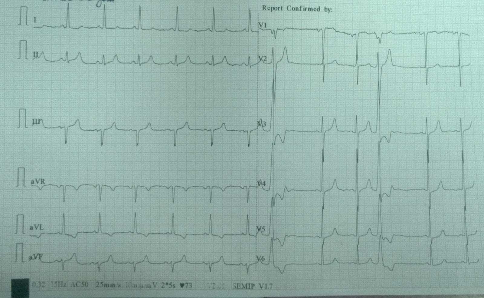 Cardiology window: Inferior wall myocardial infarction with right sided ...