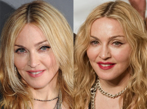 Botox: Botox e as Celebridades