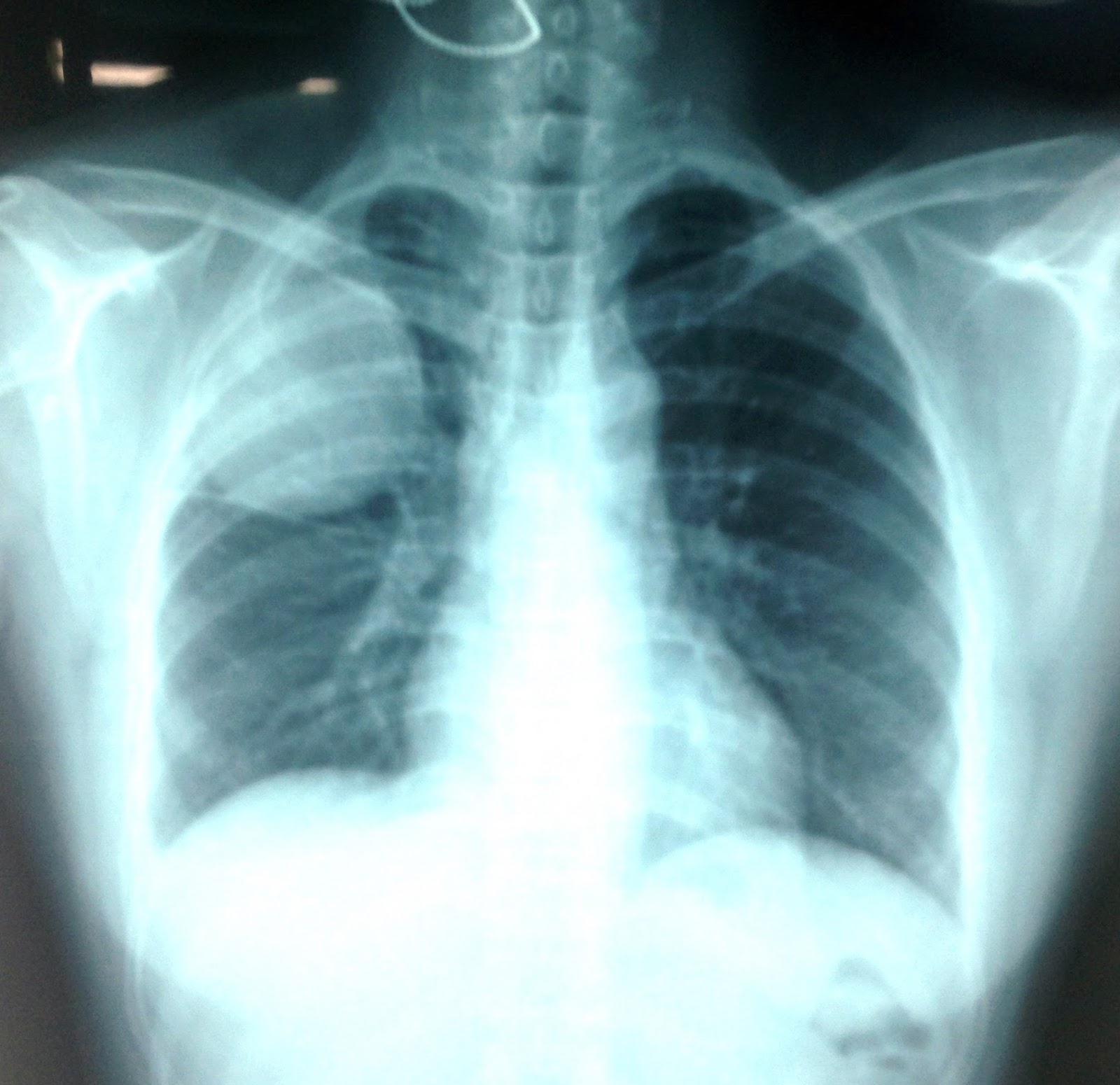 VIETNAMESE MEDIC ULTRASOUND CASE 424 LUNG TUMOR Dr PHAN THANH H I vietnamese-medic-ultrasound-case-424-lung-tumor-dr-phan-thanh-h-i
