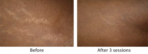 Stretch mark laser removal before & after pics | Lipstick Alley