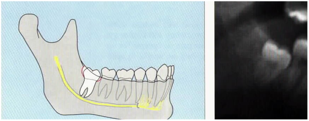 Dentistry and Medicine: Surgical management of Unerupted and Impacted teeth