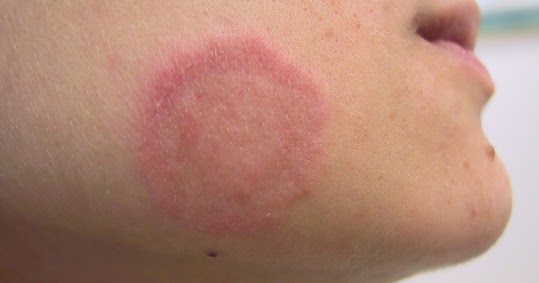 How To Get Rid of Ringworm Here Are The Effective And Useful Home ...