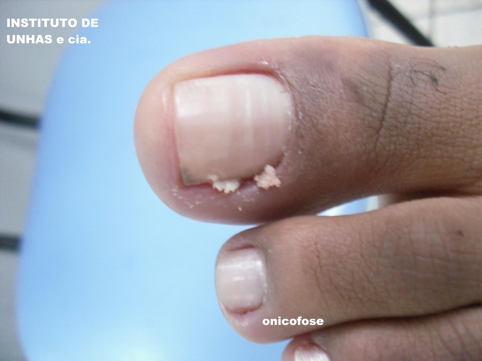 Instituto De Unhas E Cia Fone41044510 Unha Encravada