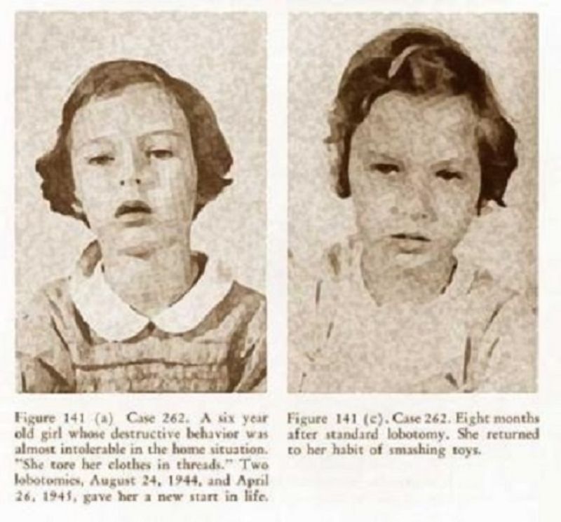 Lobotomy Procedure Through Eye