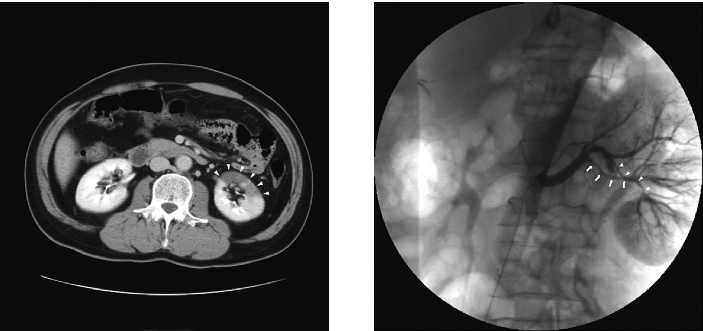 Hospitalist ~病院総合診療医~: 腎梗塞 Renal infarction