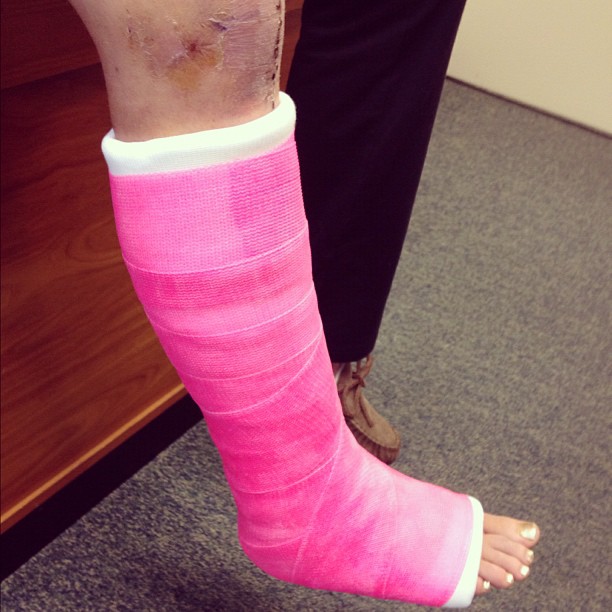 Casts and Toes: Random Cast Pics