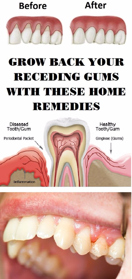 Home Remedies For Gum Disease Health Pins
