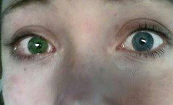 Eyes Changed Color After Corneal Crosslinking for Keratoconus 👀 ...