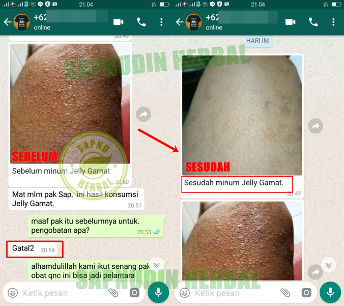 Obat Gabak Di Apotik, Mengobati Gabagen, Tampek, Kerumut / Campak ...