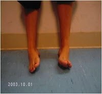 Ejercicio Terapéutico by Padrino: EJERCICIOS DE RISSER