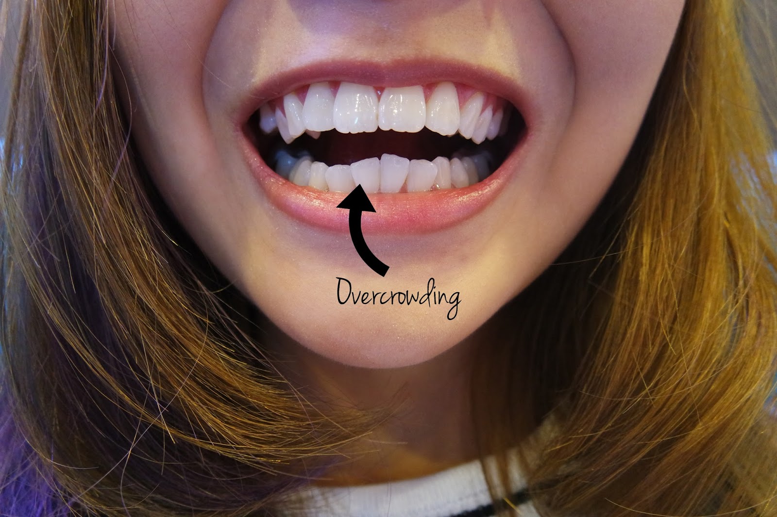 EUNICE ANNABEL: MY INVISALIGN JOURNEY AT I.DENTALSG - 5 months into ...