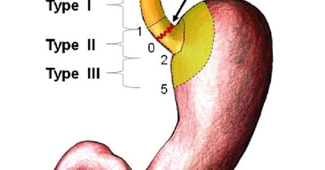 Radiotherapy Dictionary: Siewert classification