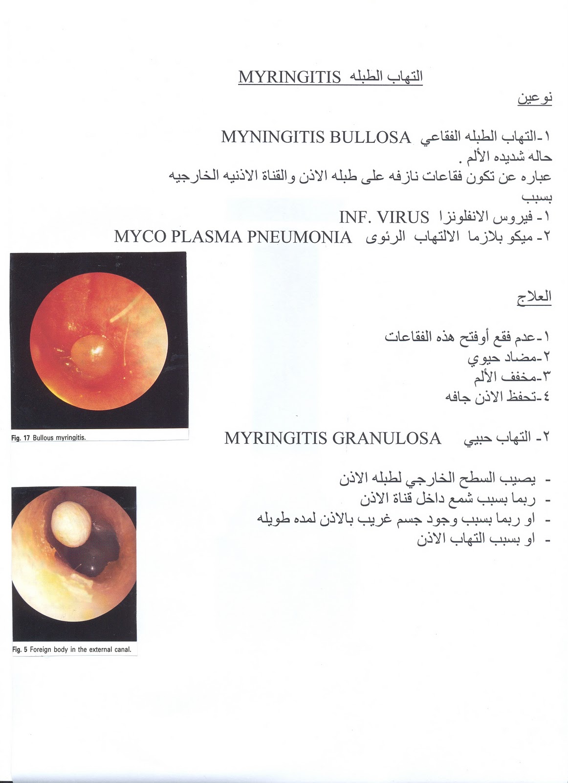 المدونة الطبية د.فهيد سالم السبيعي: التهاب طبلة الاذن MYRINGITIS