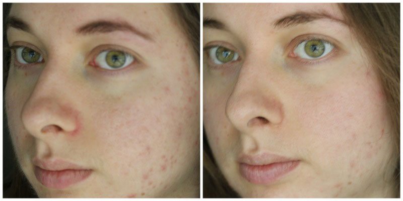 My Current Topical Acne Treatment + Battling Dry Skin ft. Acnisdin ...